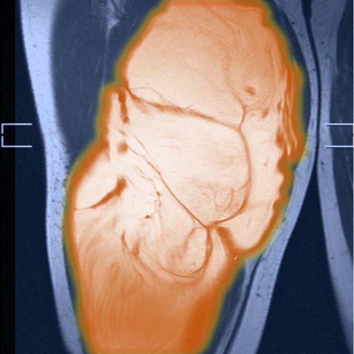 Sarcoma – Cancer Surgery Associates