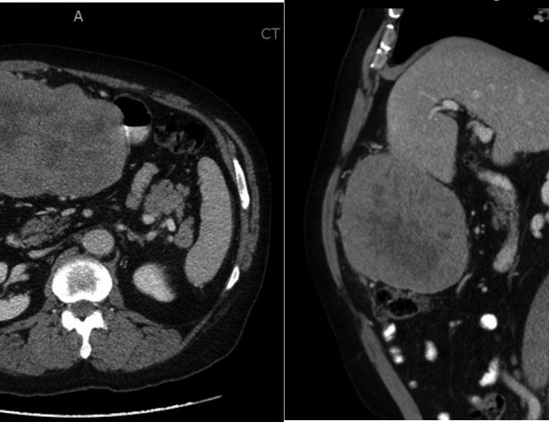 Section of Hepatopancreatobiliary (HPB) Surgery – Cancer Surgery Associates